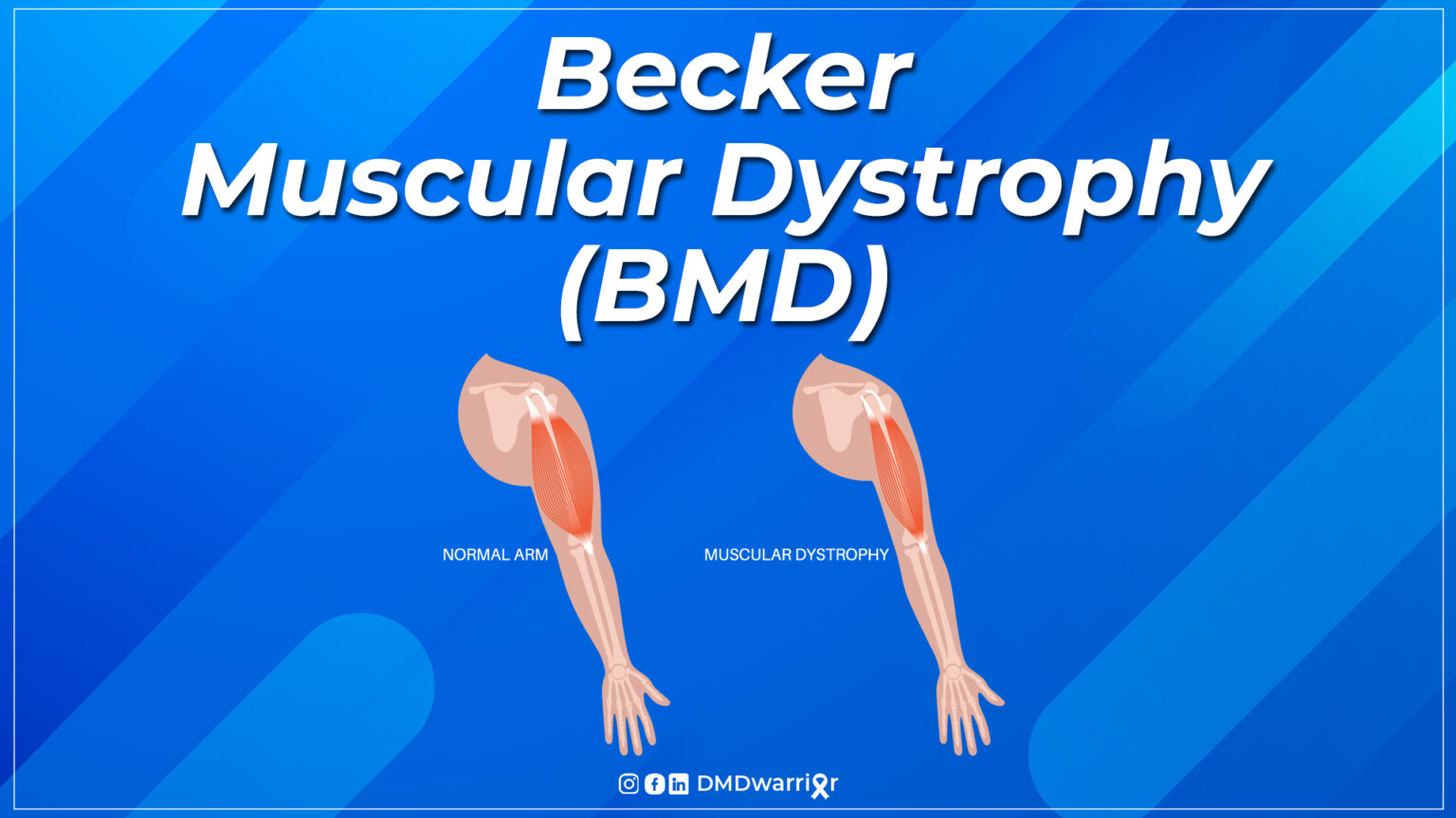 Becker Muscular Dystrophy (BMD): Symptoms, Causes, and Treatment - DMD ...