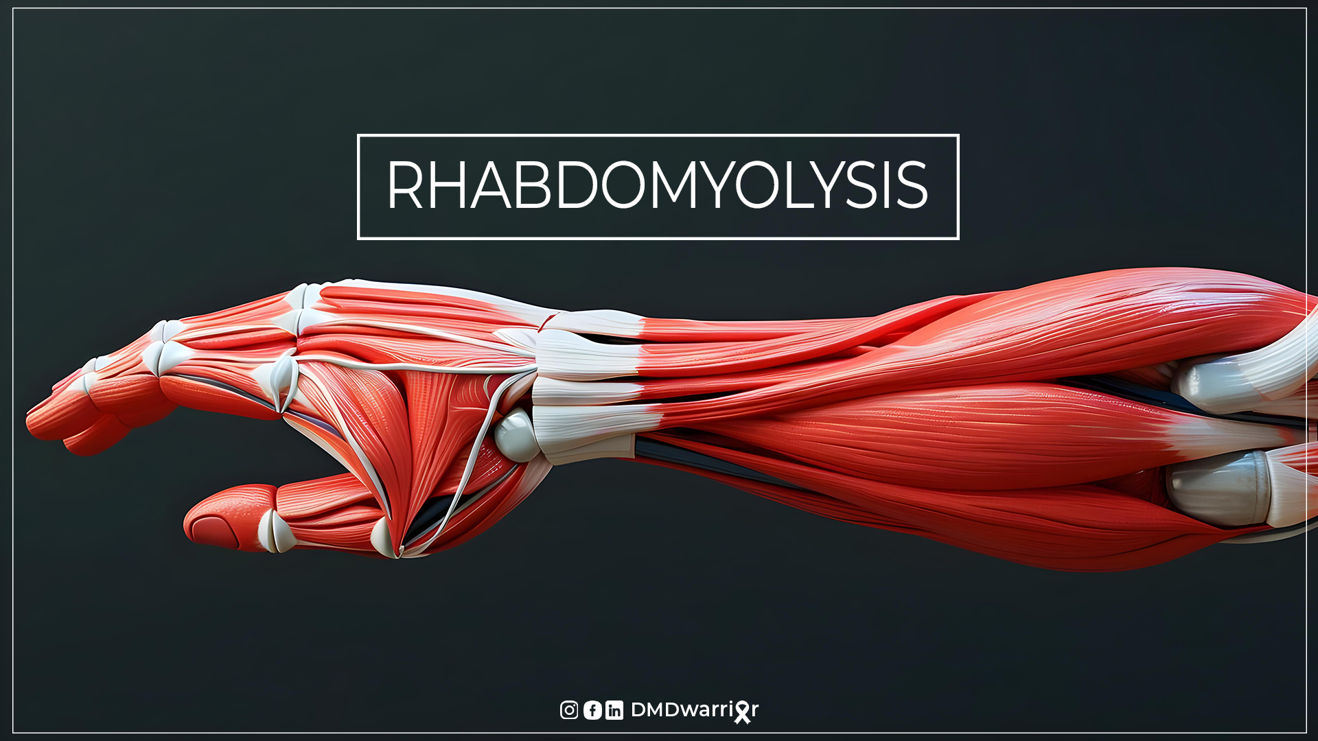 Rhabdomyolysis in Duchenne Muscular Dystrophy: Symptoms, Causes ...