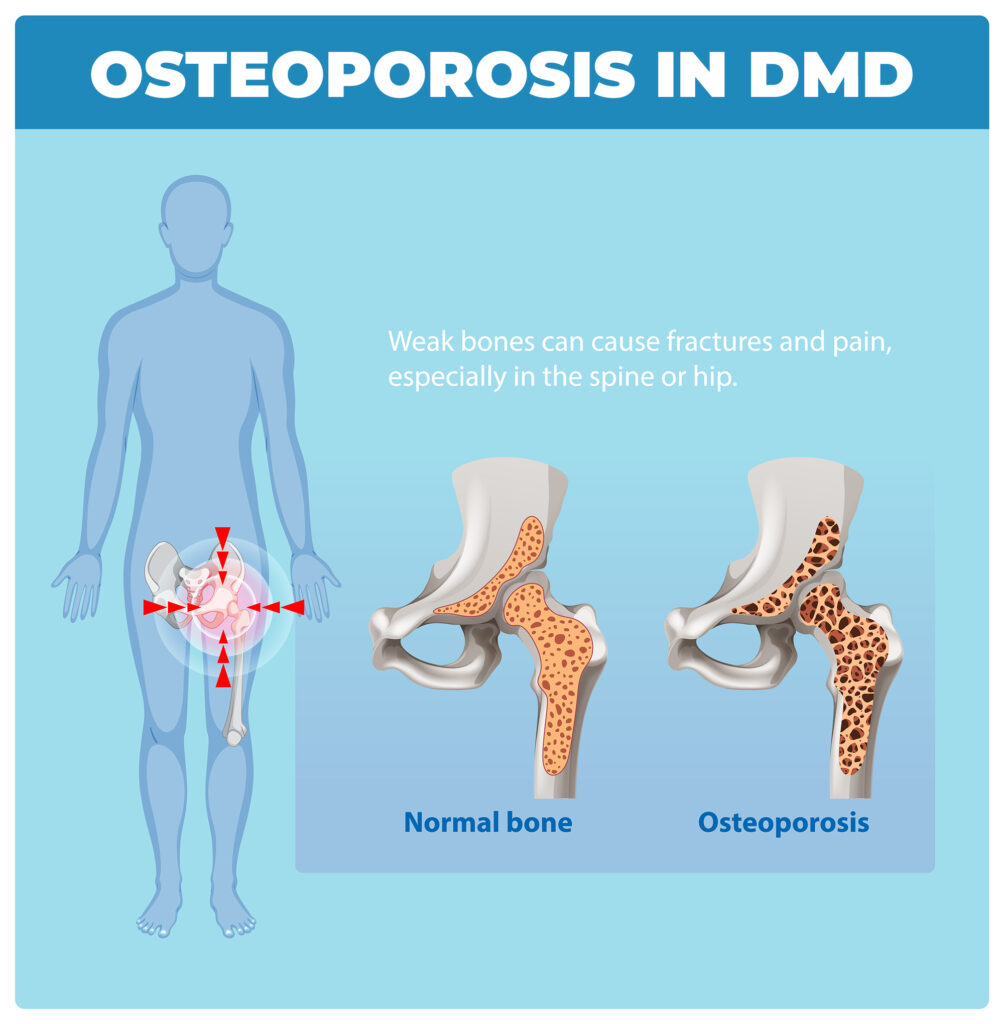 Bone & Joint Health in Duchenne Muscular Dystrophy - DMD Warrior