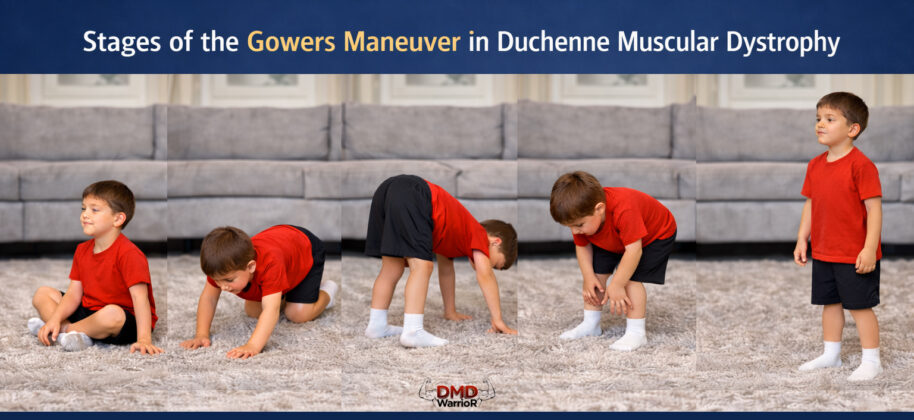 Signe de Gowers dans la dystrophie musculaire de Duchenne : 6 ...