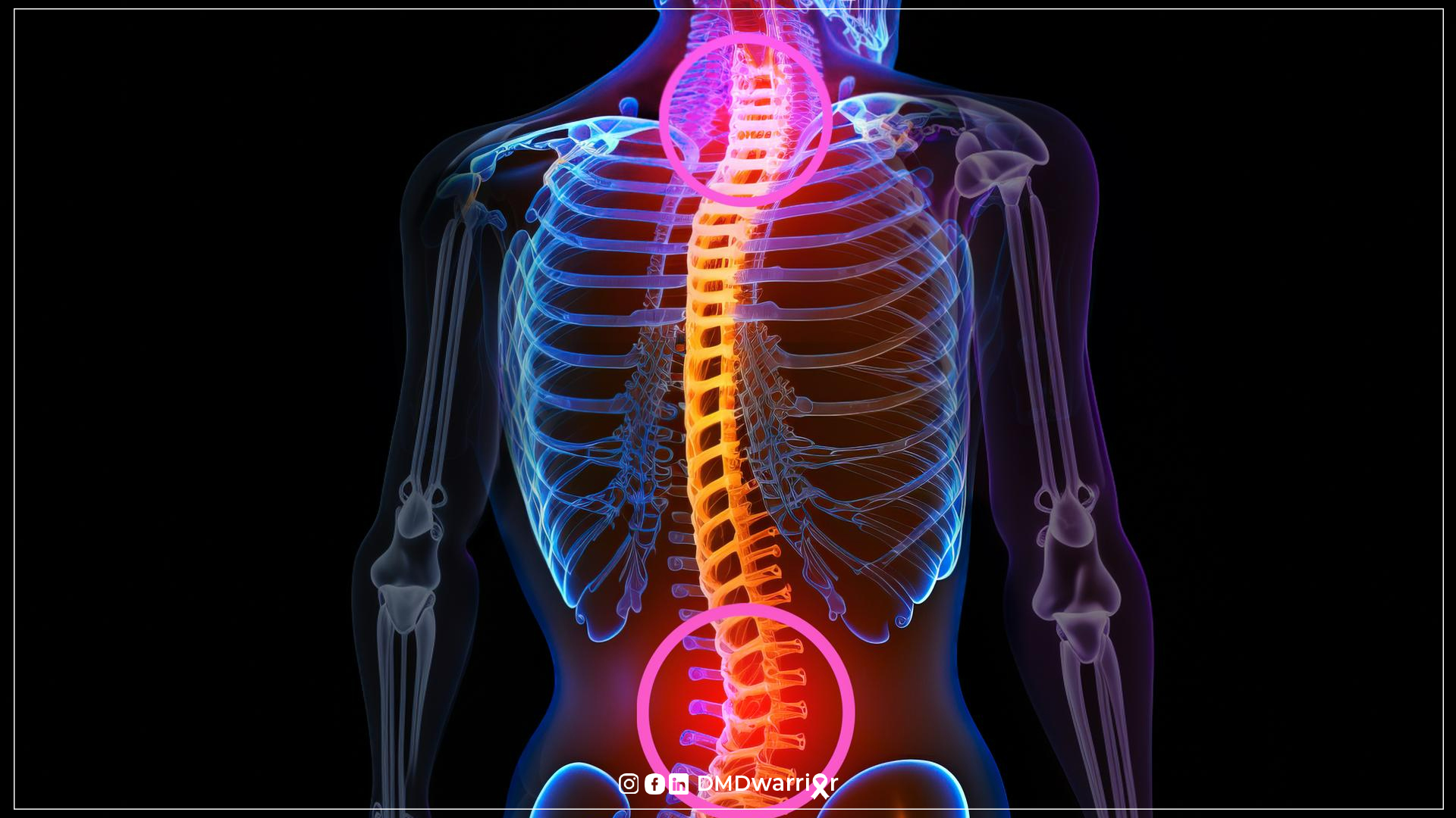 Scoliosis in Duchenne Muscular Dystrophy: 6 Effective Approaches to ...